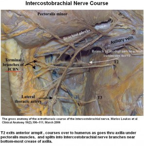 The Intercostobrachial Nerve(ICBN) -What is it and Why Can’t Breast Cancer Surgeons Deal Better ...
